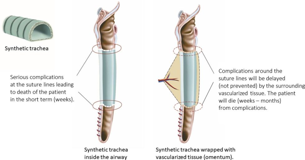 Commentary: The sobering truth about tracheal regeneration ...